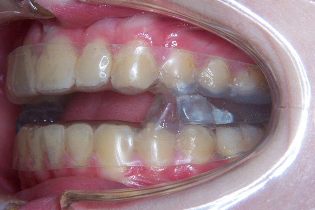 Retention and Quality control (IOTN-PAR) | IOS